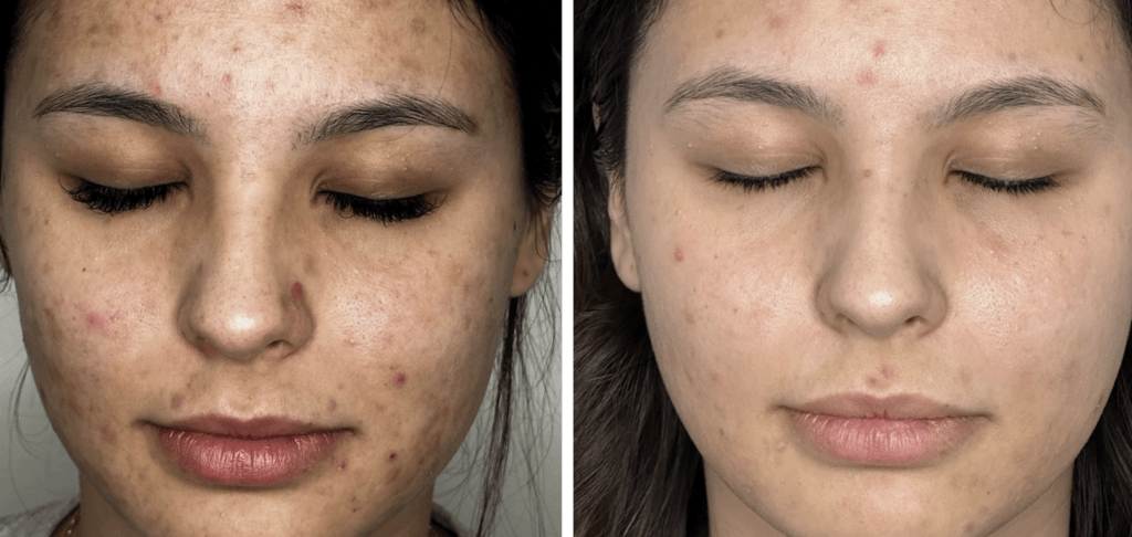 Transforming Skin with Laser: Beyond Hair Removal – Wrapture Beauty Academy